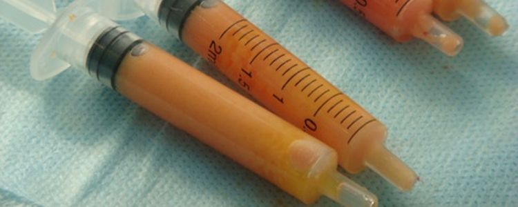 Adipose tissue from first donor for skin bank formation - People’s ...